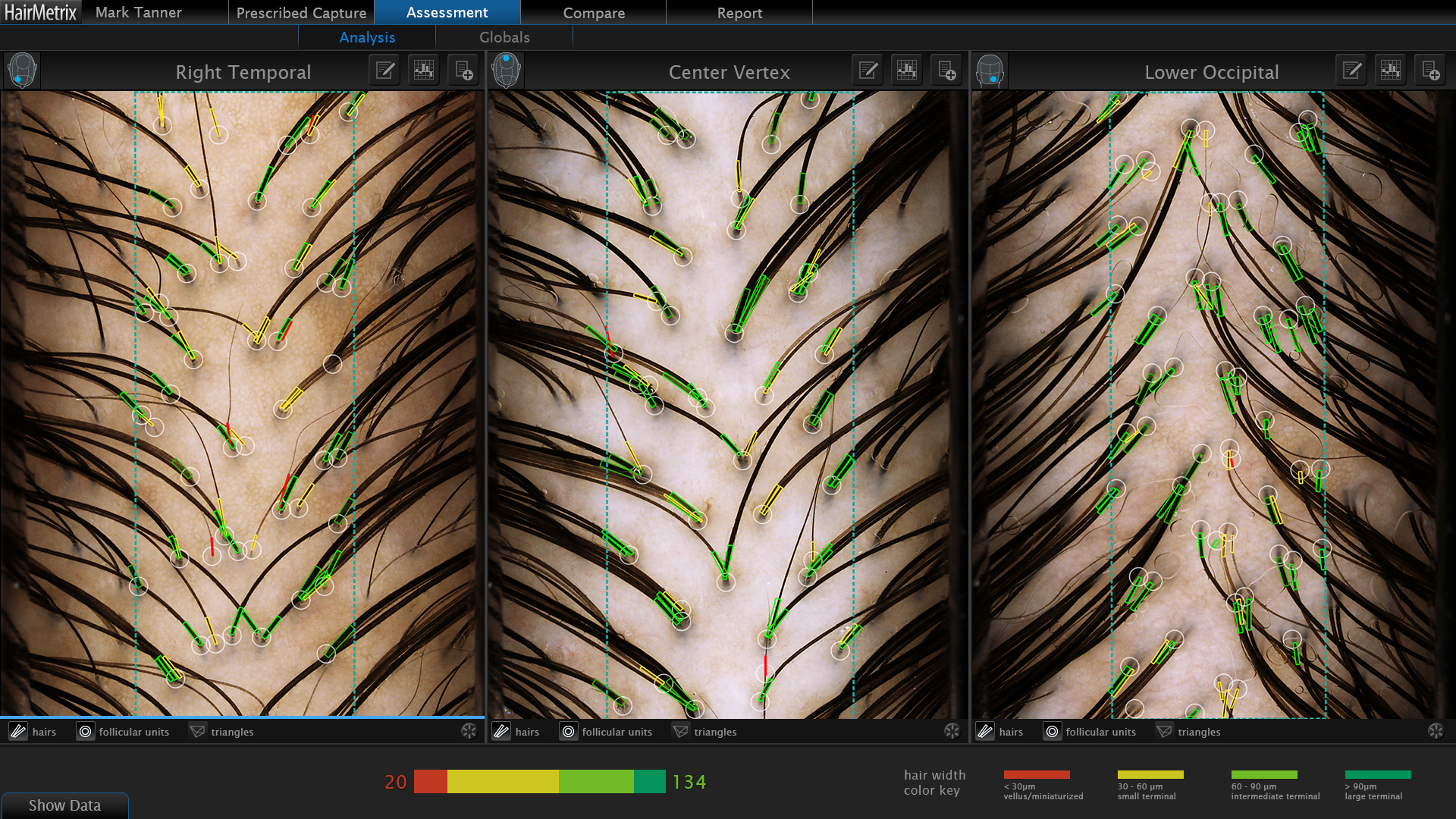 Hairmetrix Vs. Traditional Methods Redefining Hair Consultations With ...